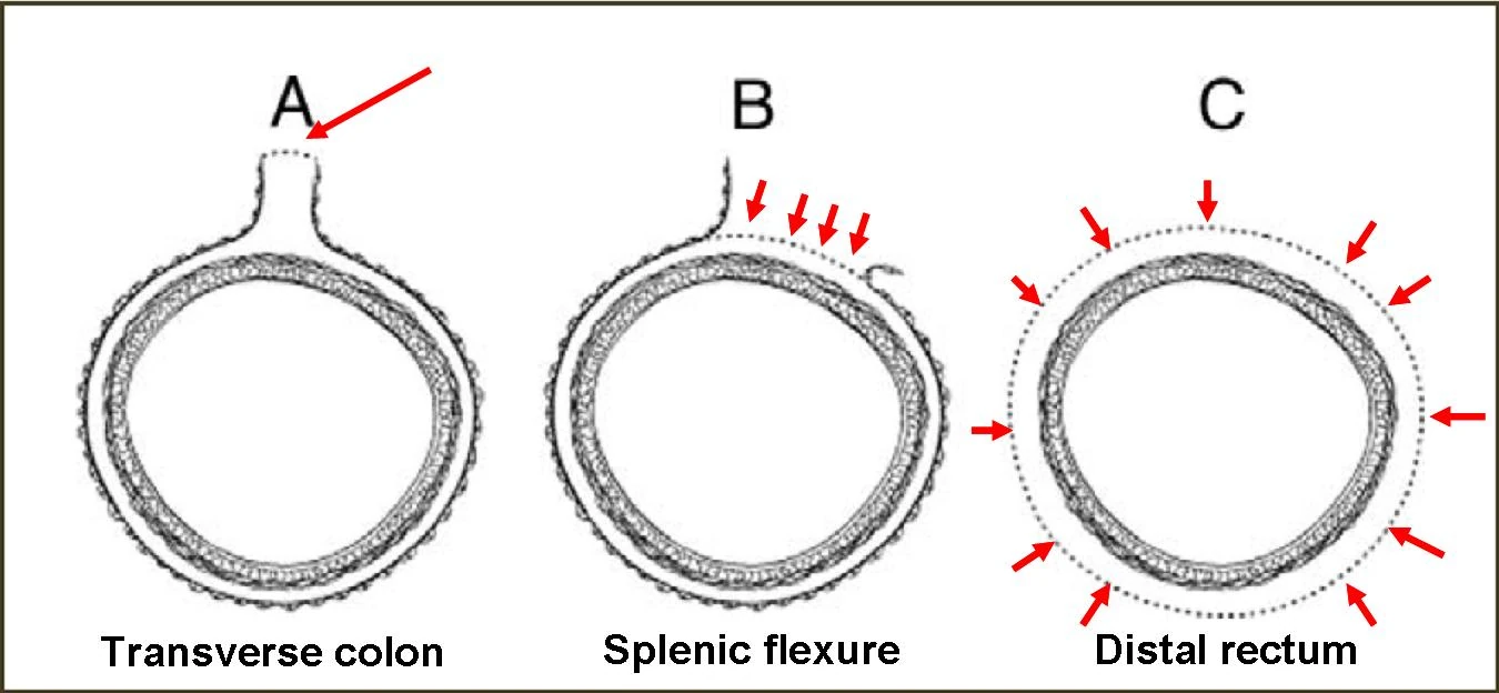 Image - Rectum radial margins.jpg - Pathology Resident Wiki
